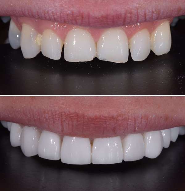 Composite Bonding Stockport, Cheshire | Cosmetic Bonding Experts